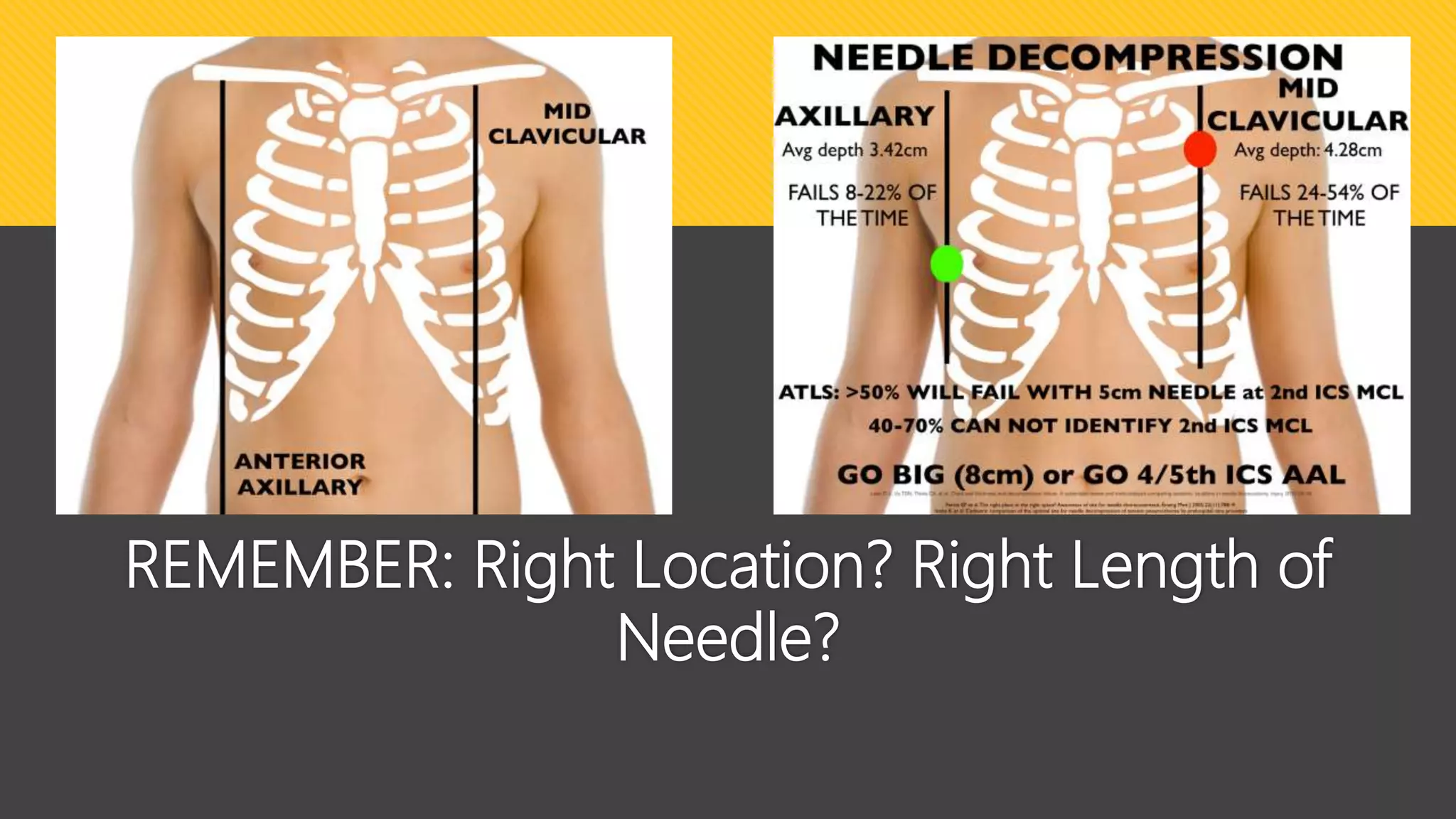 2020 fun with thoracostomy's | PPTX