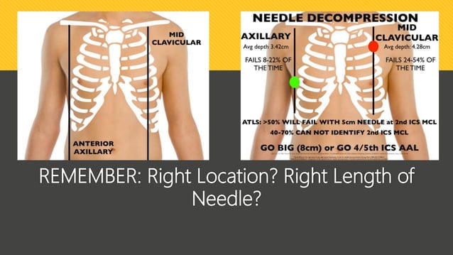 2020 fun with thoracostomy's | PPT