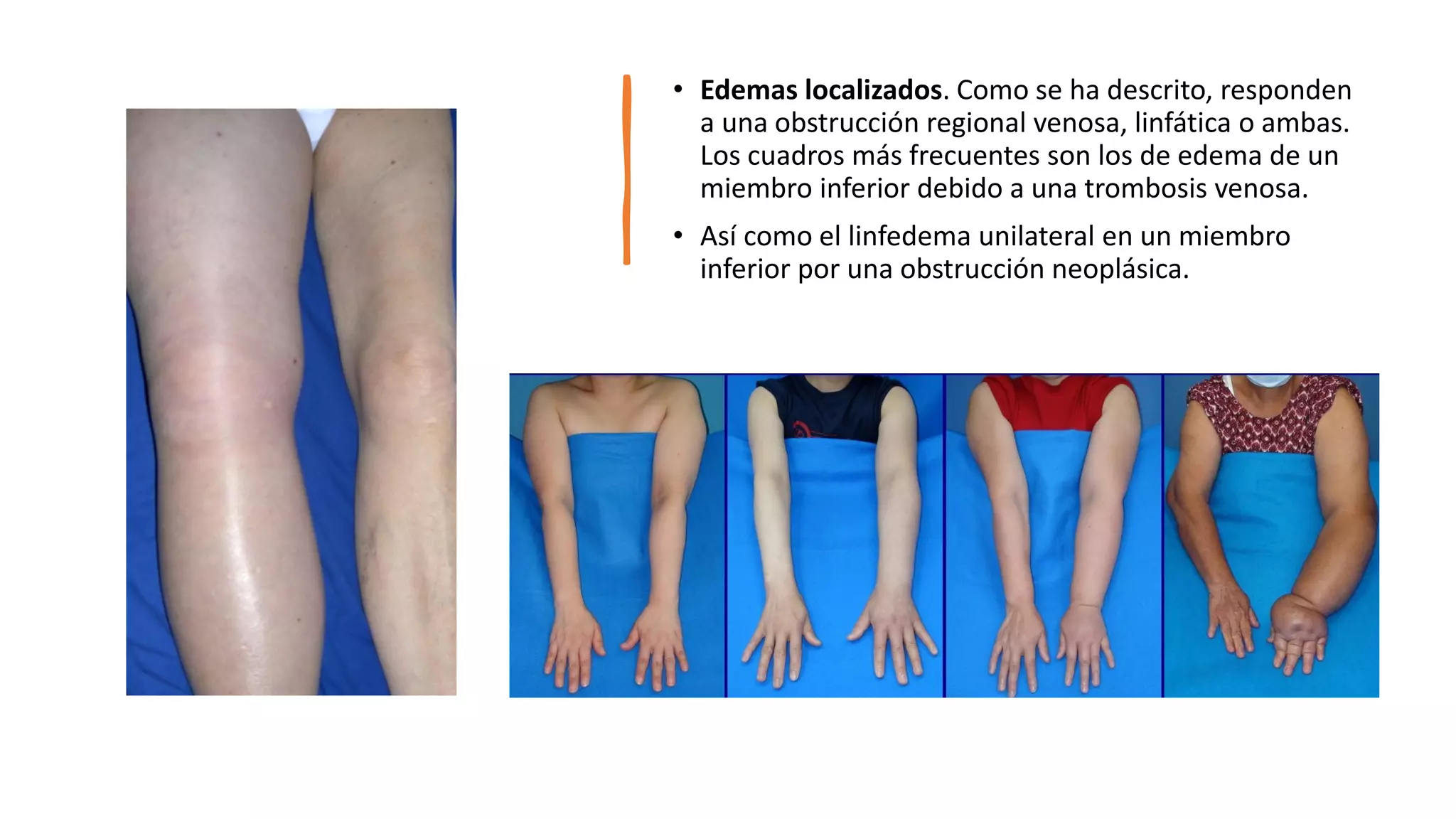 (2021 06-17) edemas (ppt) | PDF