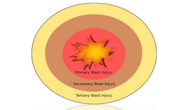 2021-Explosion Injuries-RP.pptx