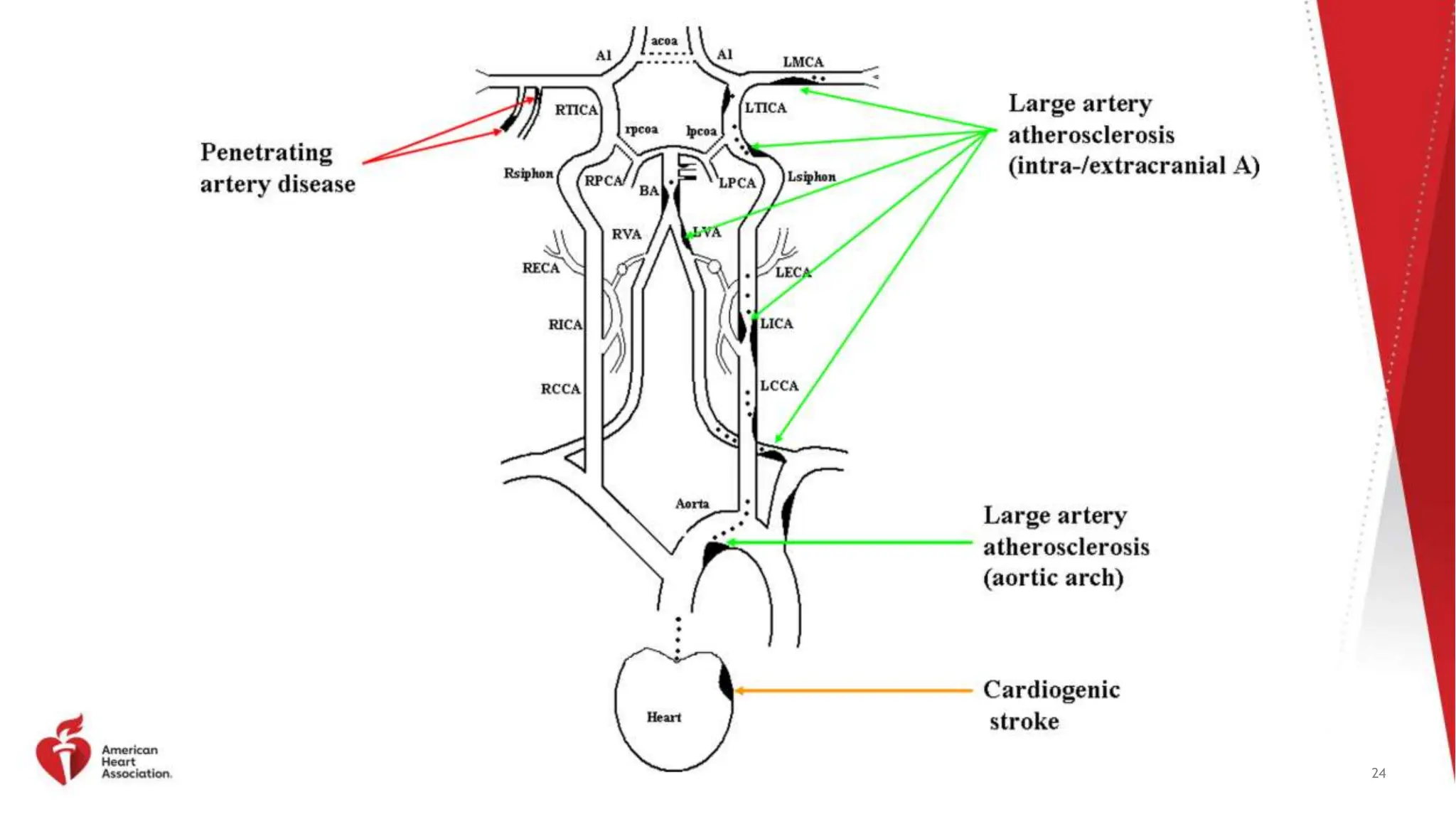 2021 AHA ASA Guideline for the Prevention of Stroke in Patients With ...