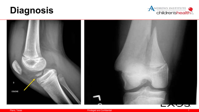Pediatric ACL Injuries | PPTX