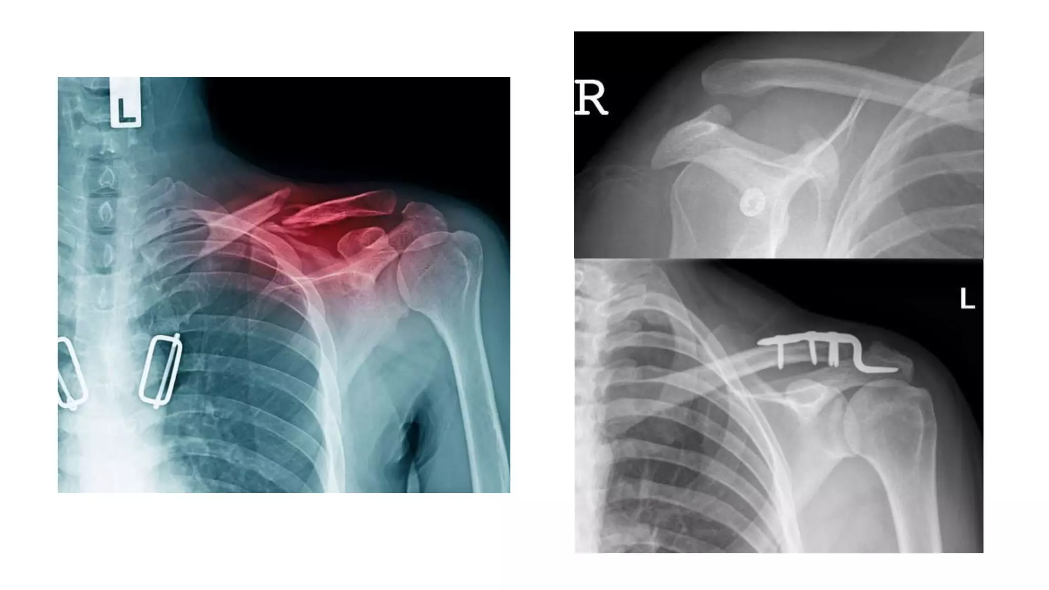 2021 KSRA clavicle innervation | PPTX