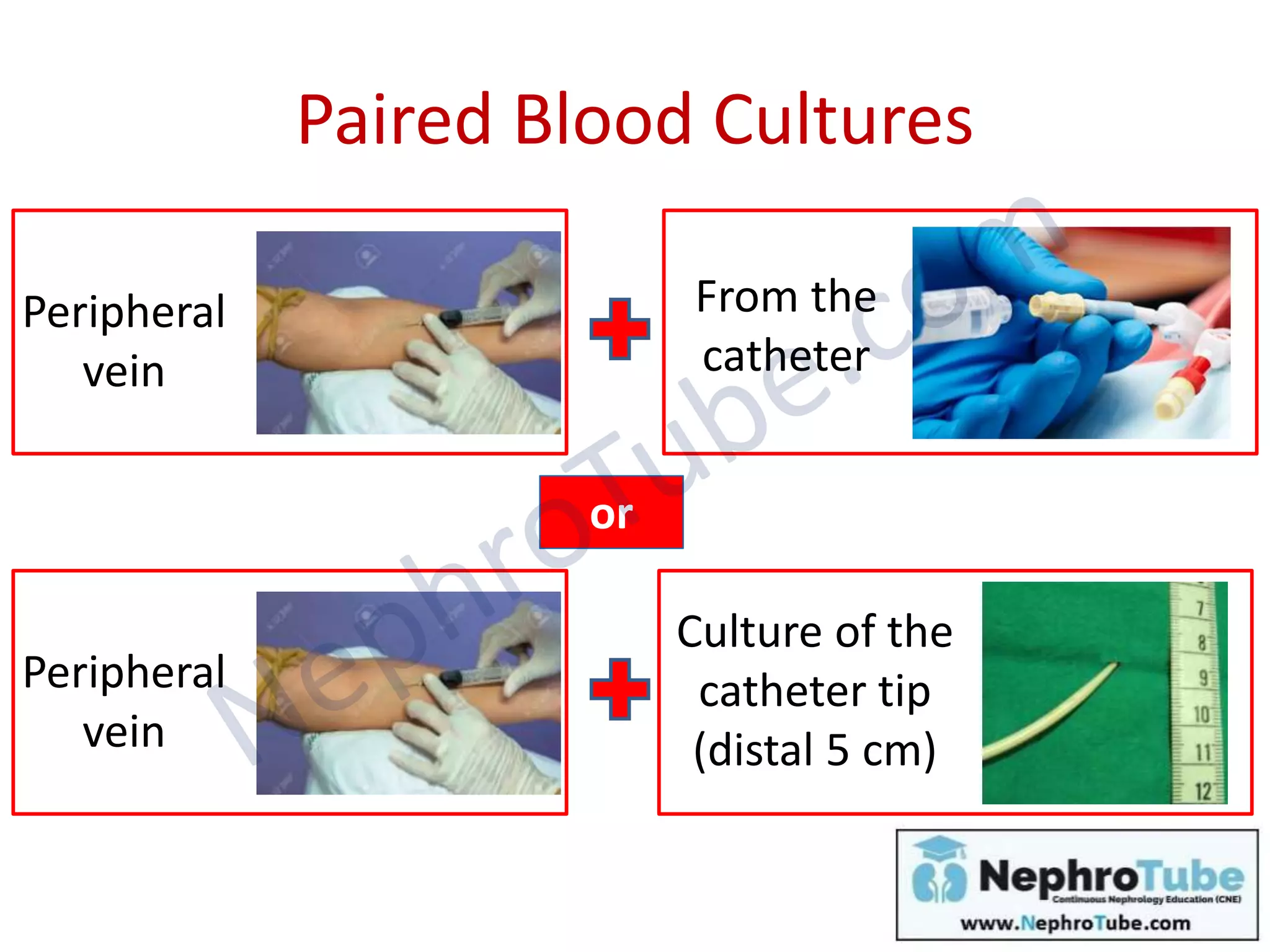 Catheter Related Blood Stream Infection (CRBSI) - (Diagnosis ...
