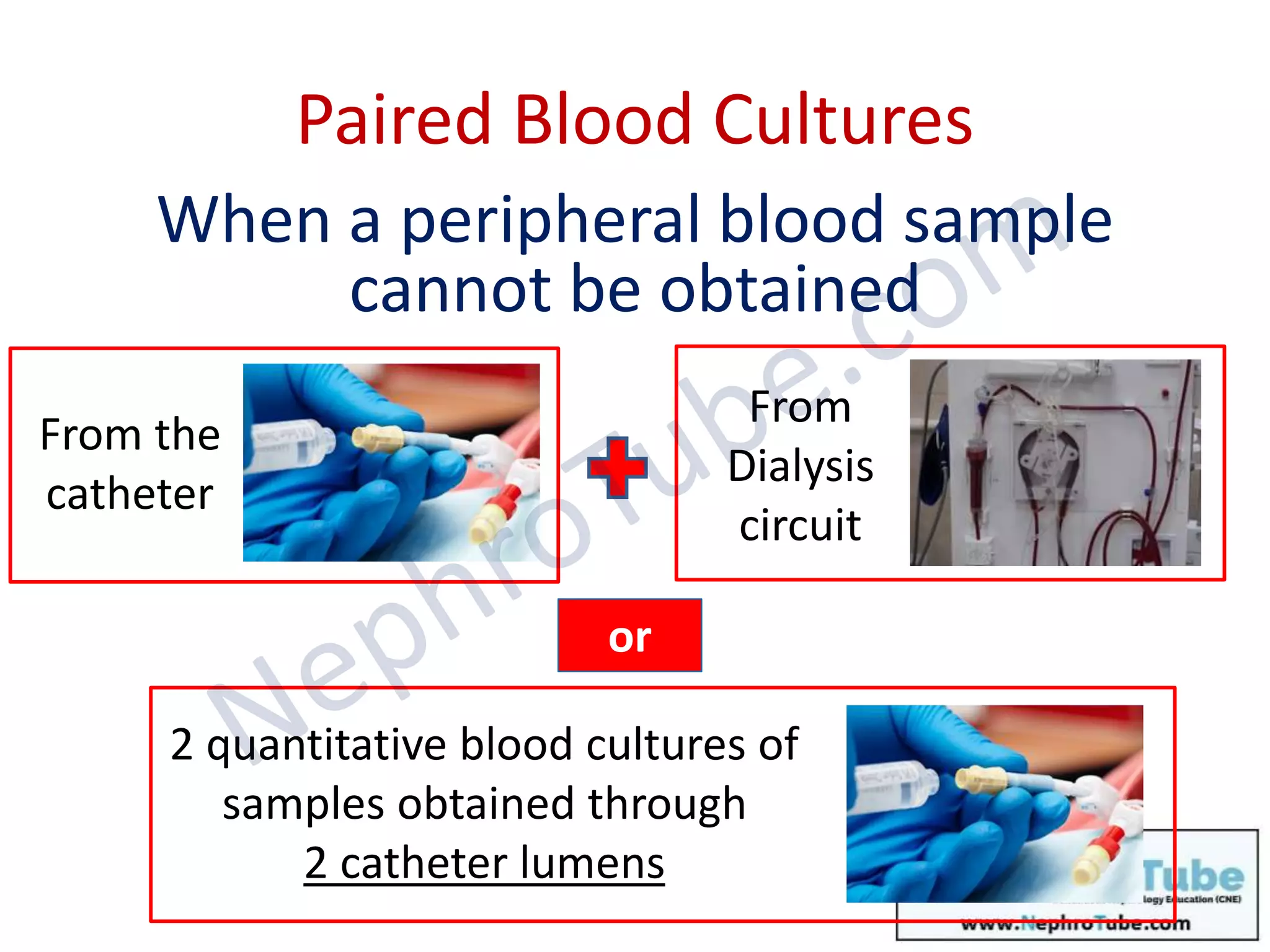 Catheter Related Blood Stream Infection (CRBSI) - (Diagnosis ...