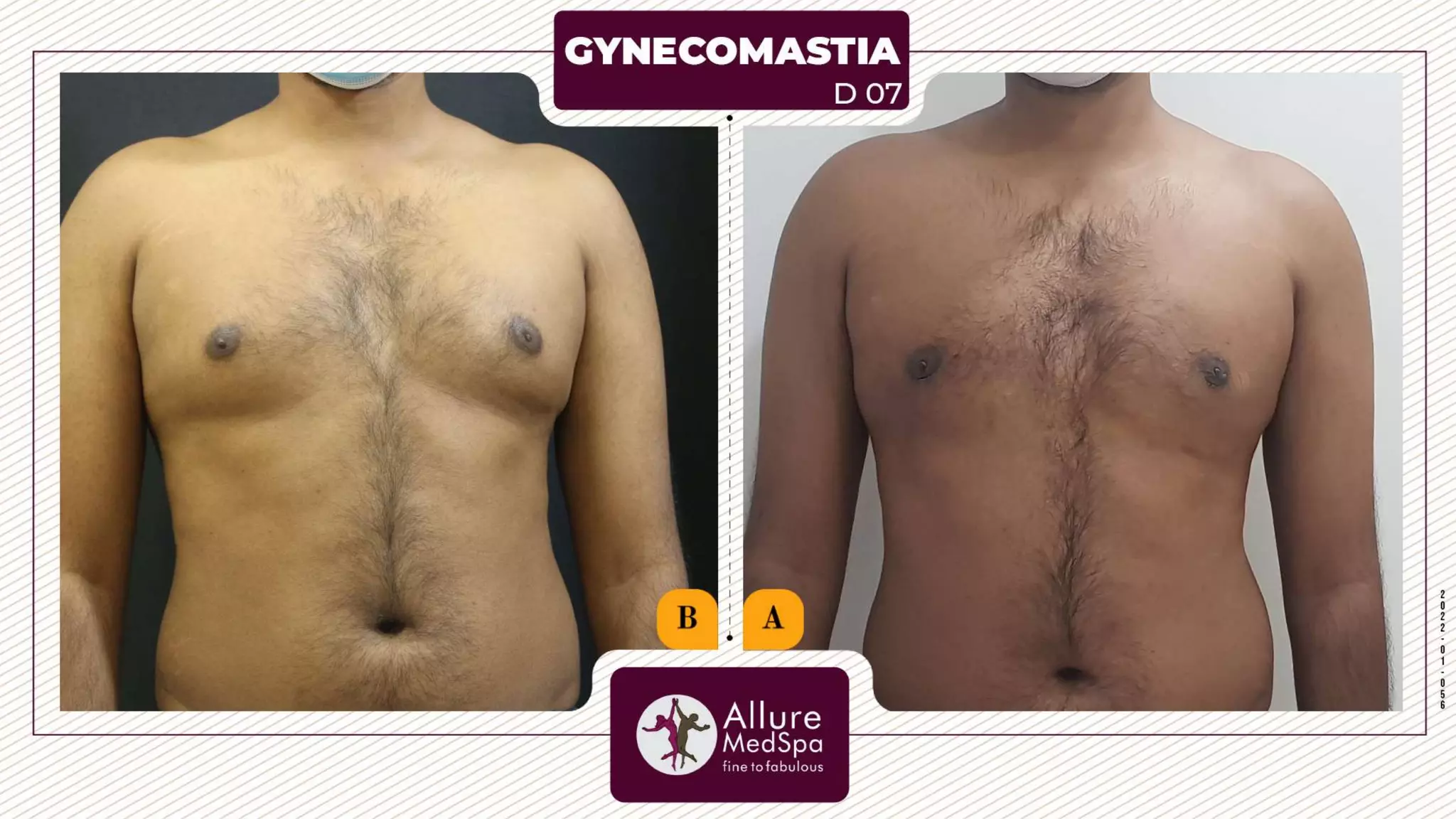 What is Gynecomastia? Surgery in Allure Medspa | PPTX