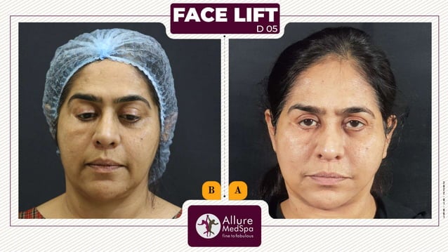 Face lift Surgery | Allure Medspa | Dr.Milan Doshi | PPTX
