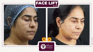 Face lift Surgery | Allure Medspa | Dr.Milan Doshi | PPT