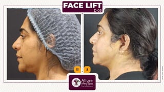 Face lift Surgery | Allure Medspa | Dr.Milan Doshi | PPTX