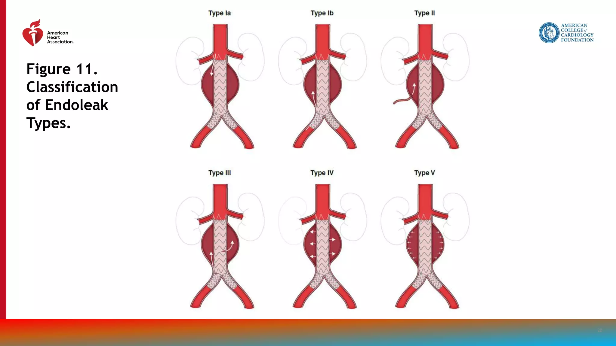 2022-Aortic-Disease-guidelines-ppt | PPTX