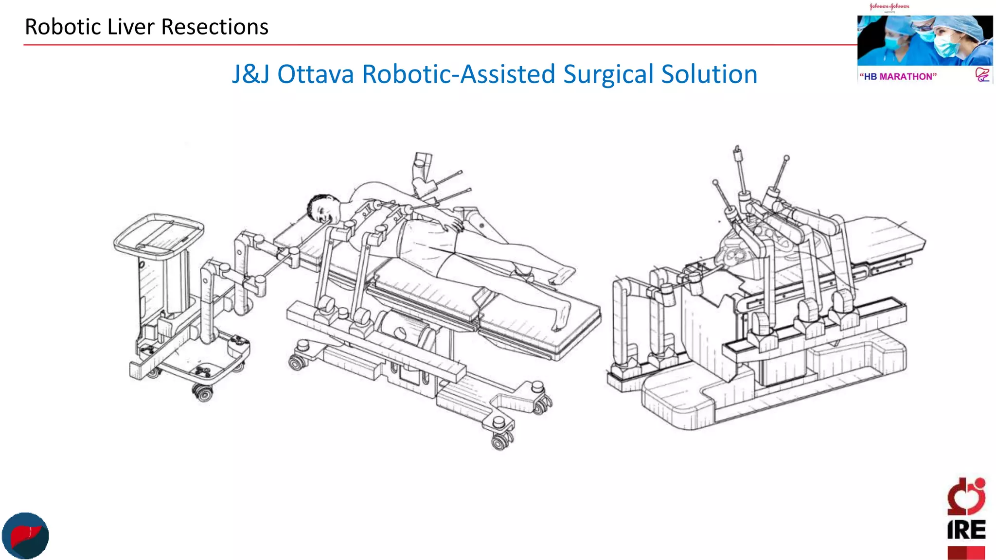 State of the art of robotic surgery in the liver | PPTX