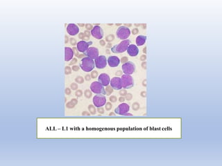 Leukemias | PPTX