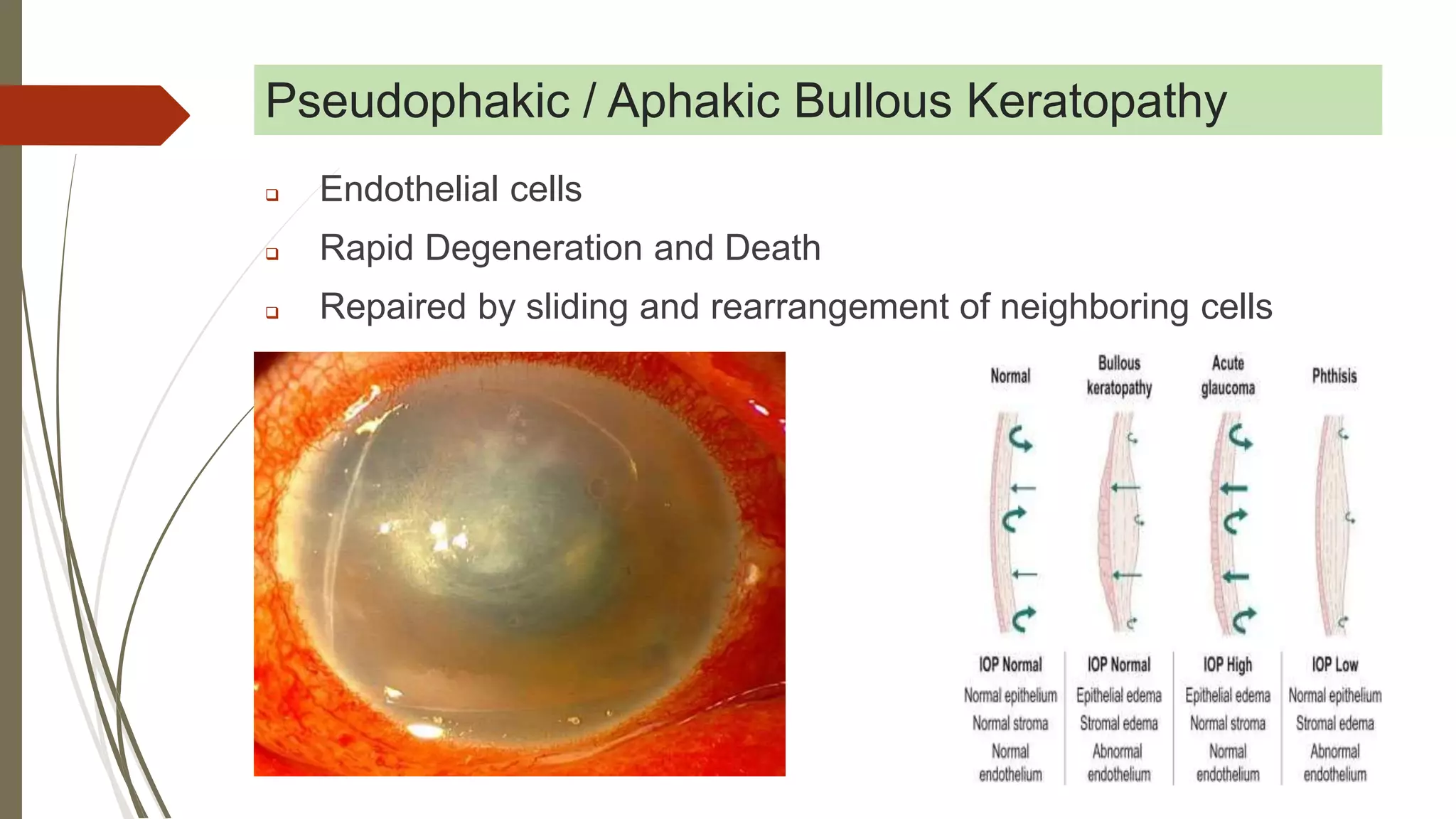 2022_0424_Bullous Keratopathy.ppt