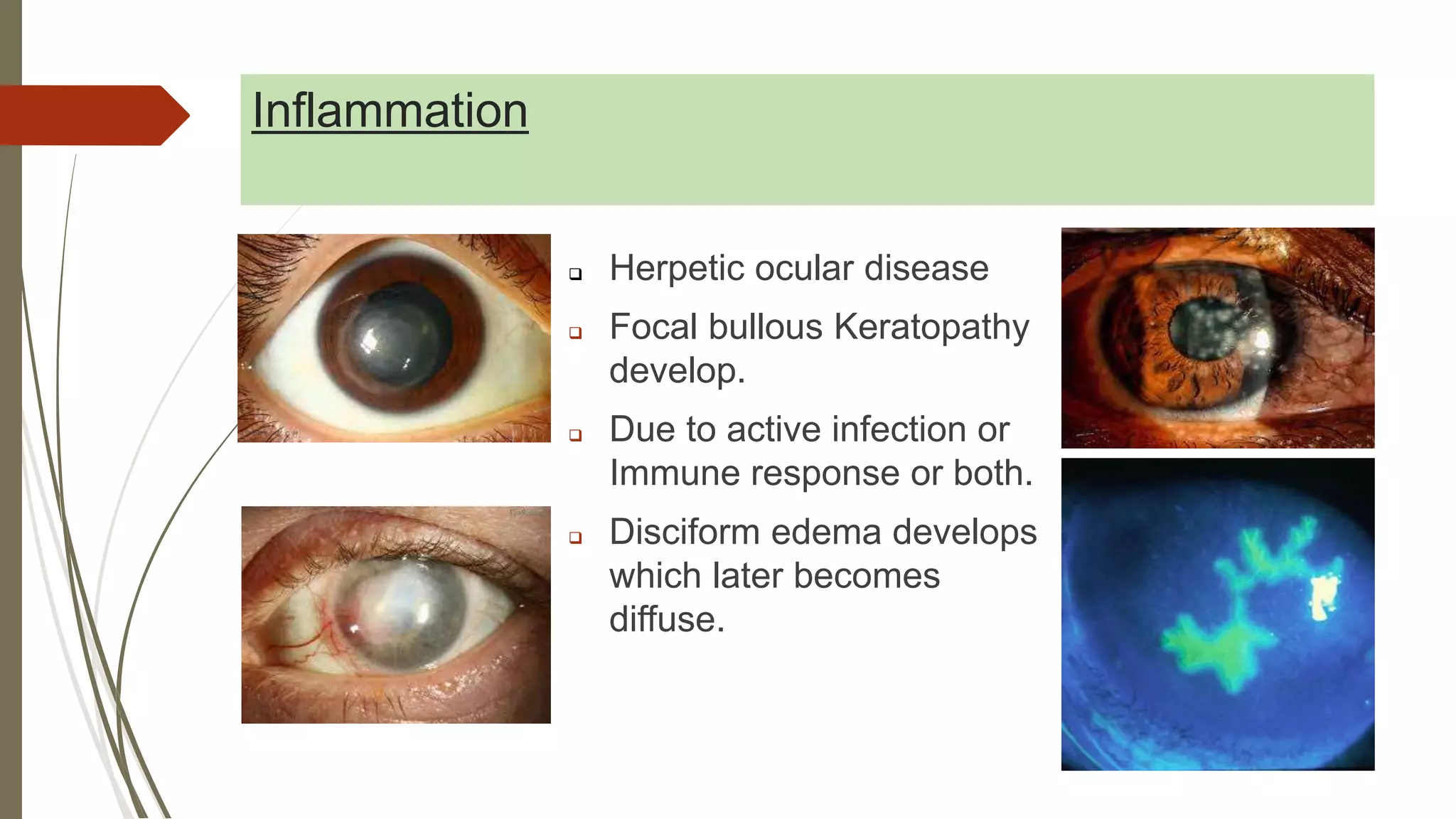 2022_0424_Bullous Keratopathy.ppt