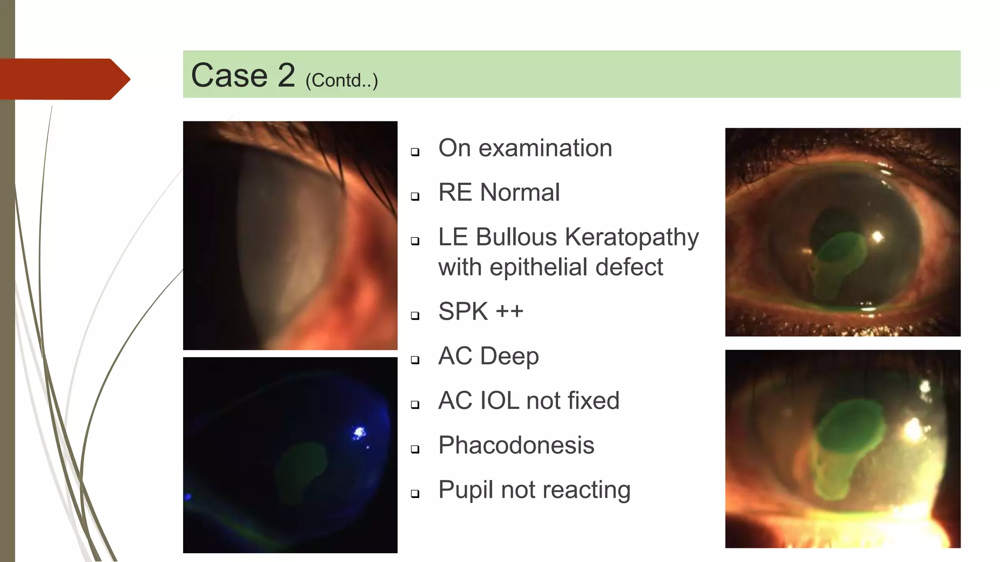 2022_0424_Bullous Keratopathy.ppt