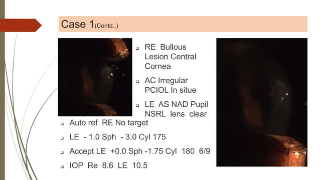 2022_0424_Bullous Keratopathy.ppt | Eye and Vision Conditions ...