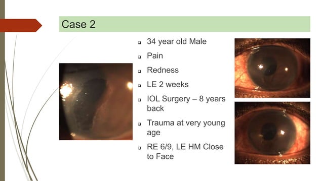 2022_0424_Bullous Keratopathy.ppt | Eye and Vision Conditions ...