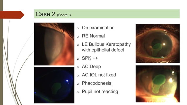 2022_0424_Bullous Keratopathy.ppt | Eye and Vision Conditions ...