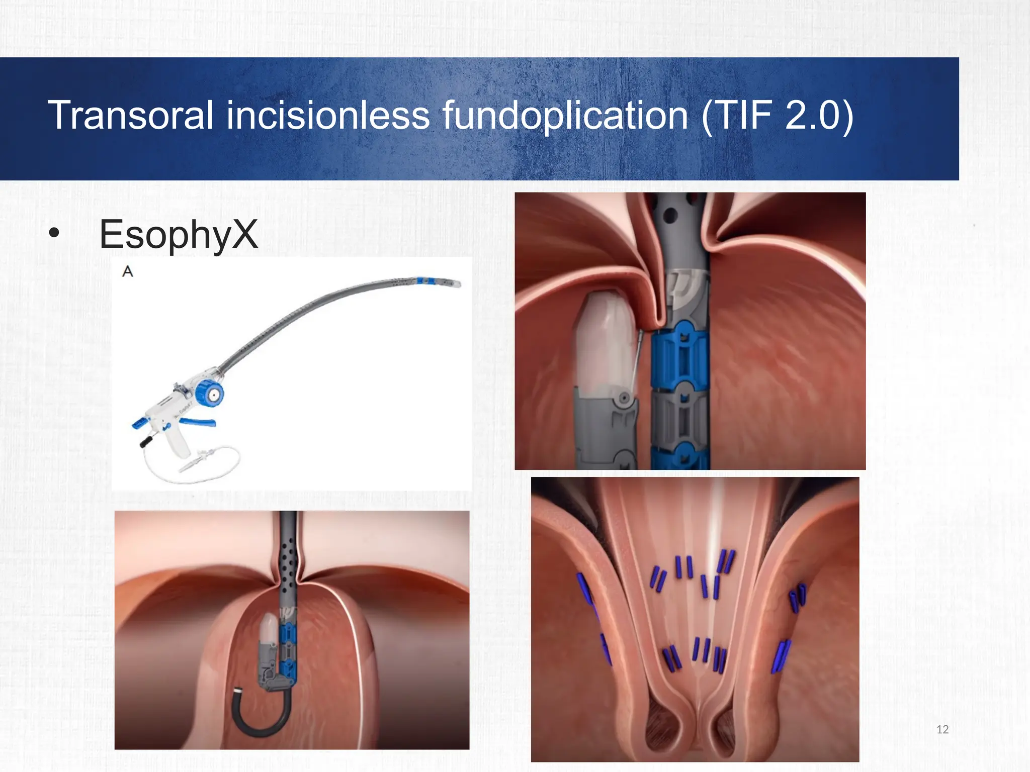 General surgery for gastroesophageal Reflux Disease | PPTX