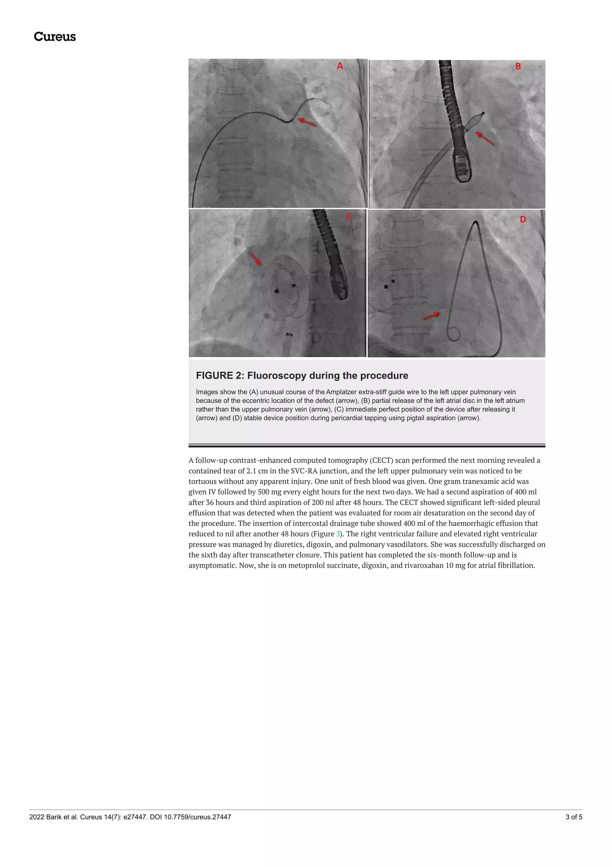 A Case of Device Closure of an Eccentric Atrial Septal Defect Using a ...