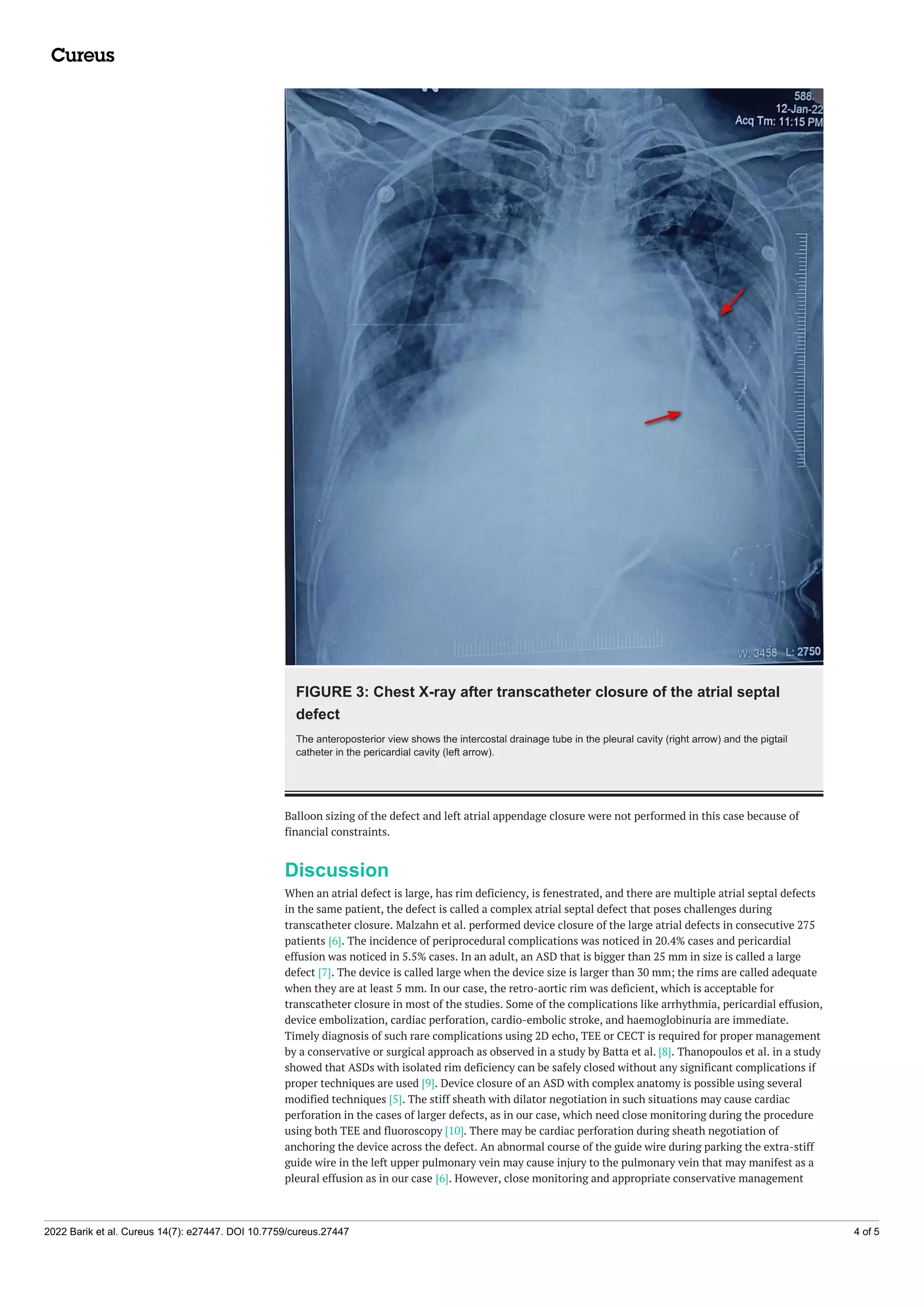 A Case of Device Closure of an Eccentric Atrial Septal Defect Using a ...