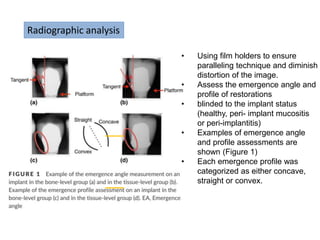 20220919 implant LL - Restoration contour is a risk indicator for peri ...
