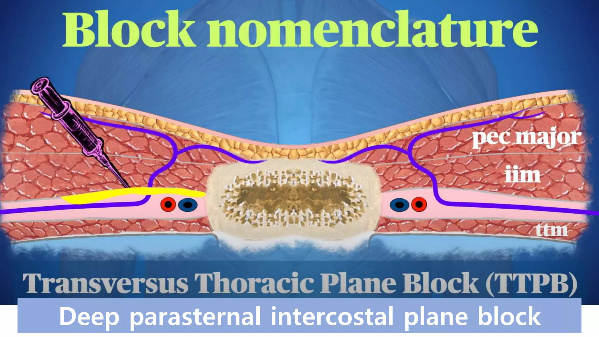 2022 KSCTVA Sono-guided nerve blocks for cardio-thoracic surgery.pptx