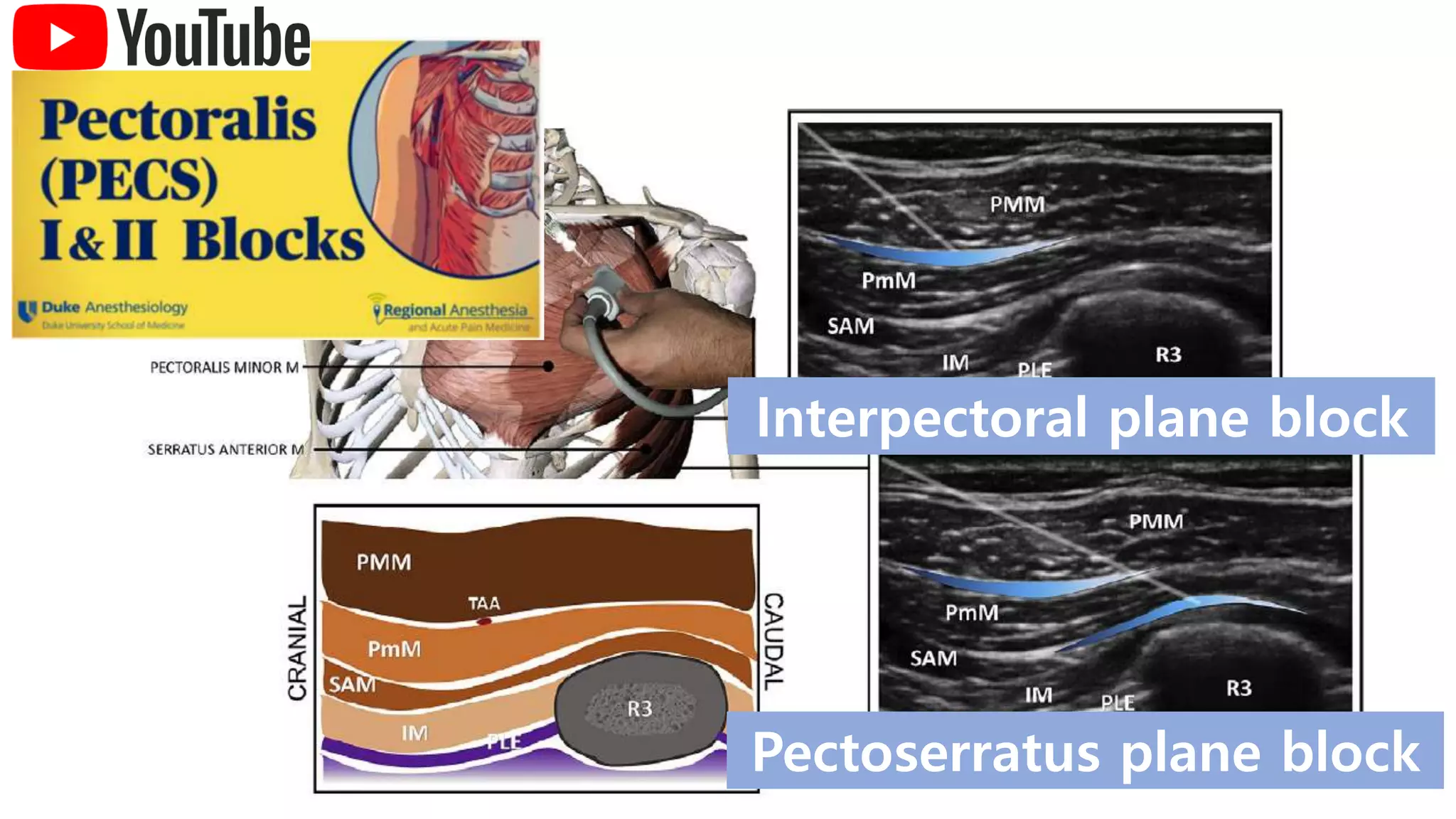 2022 KSCTVA Sono-guided nerve blocks for cardio-thoracic surgery.pptx