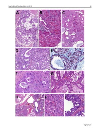 2022 WHO Salivary gland tumors update.pdf