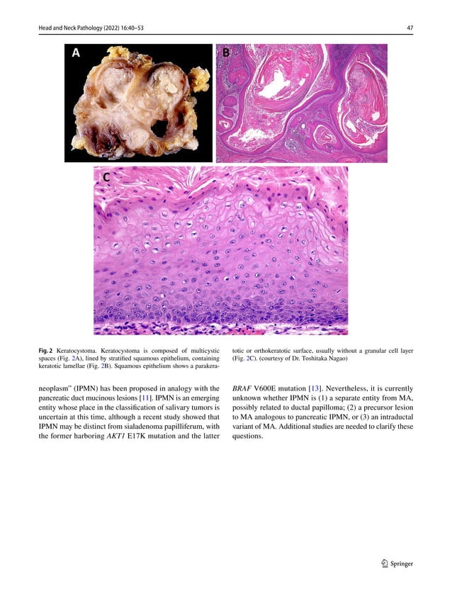 2022 WHO Salivary gland tumors update.pdf