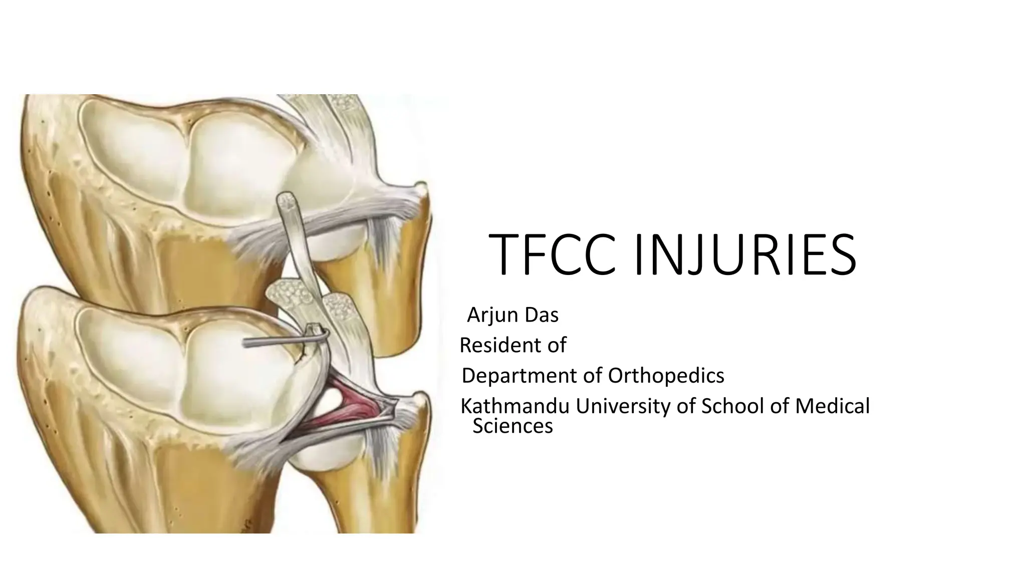 TRIANGULAR FIBROCARTILAGE COMPLEX, TFCC INJURY , DR ARJUN , | PPTX