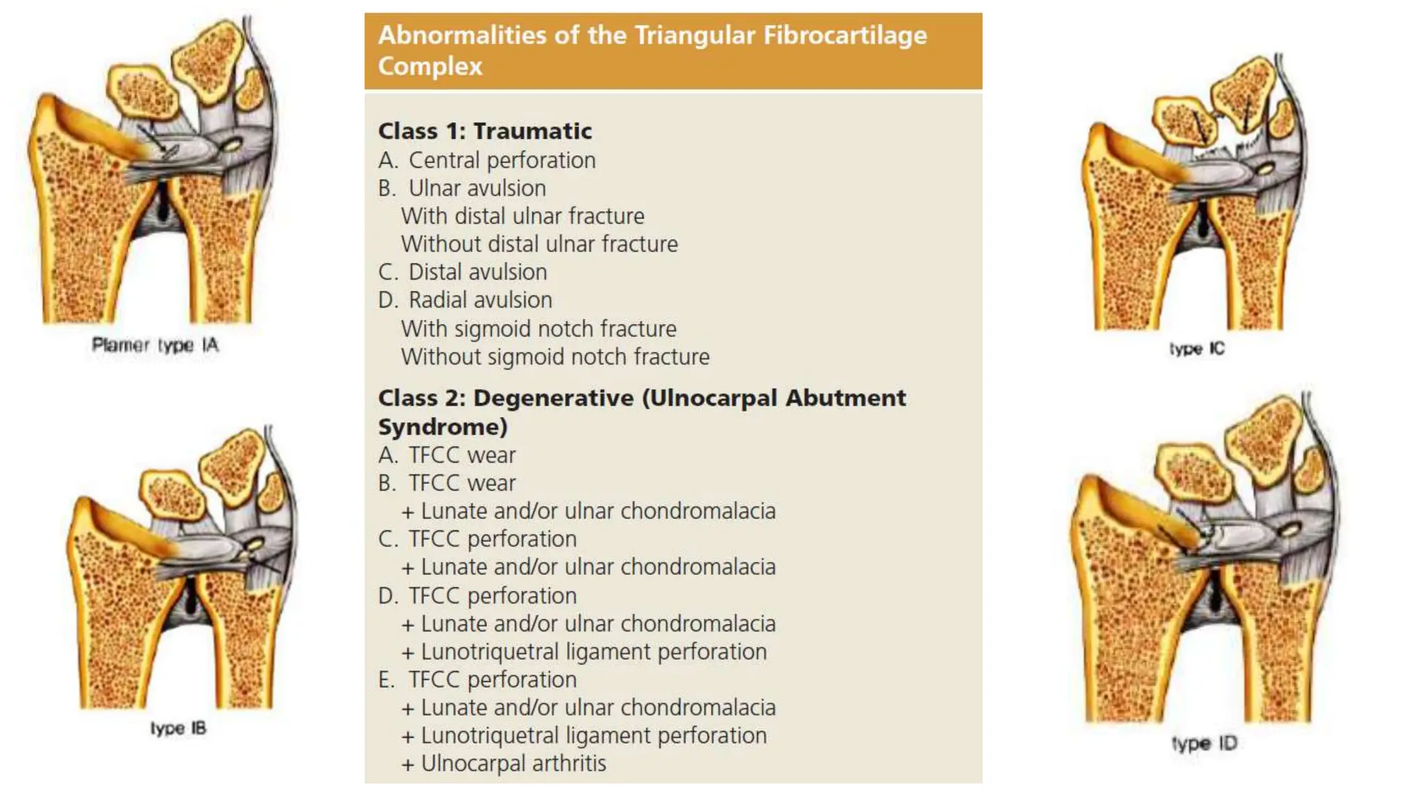 TRIANGULAR FIBROCARTILAGE COMPLEX, TFCC INJURY , DR ARJUN , | PPTX