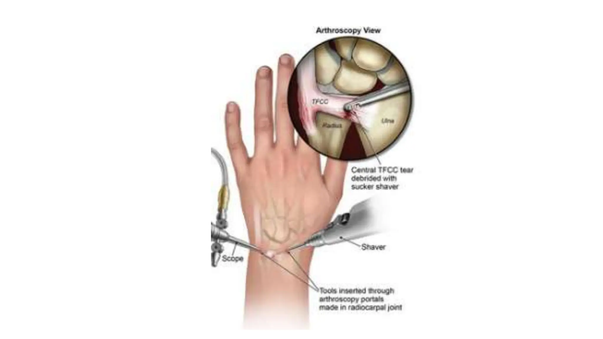 TRIANGULAR FIBROCARTILAGE COMPLEX, TFCC INJURY , DR ARJUN , | PPTX | Death, Injury, or Military ...
