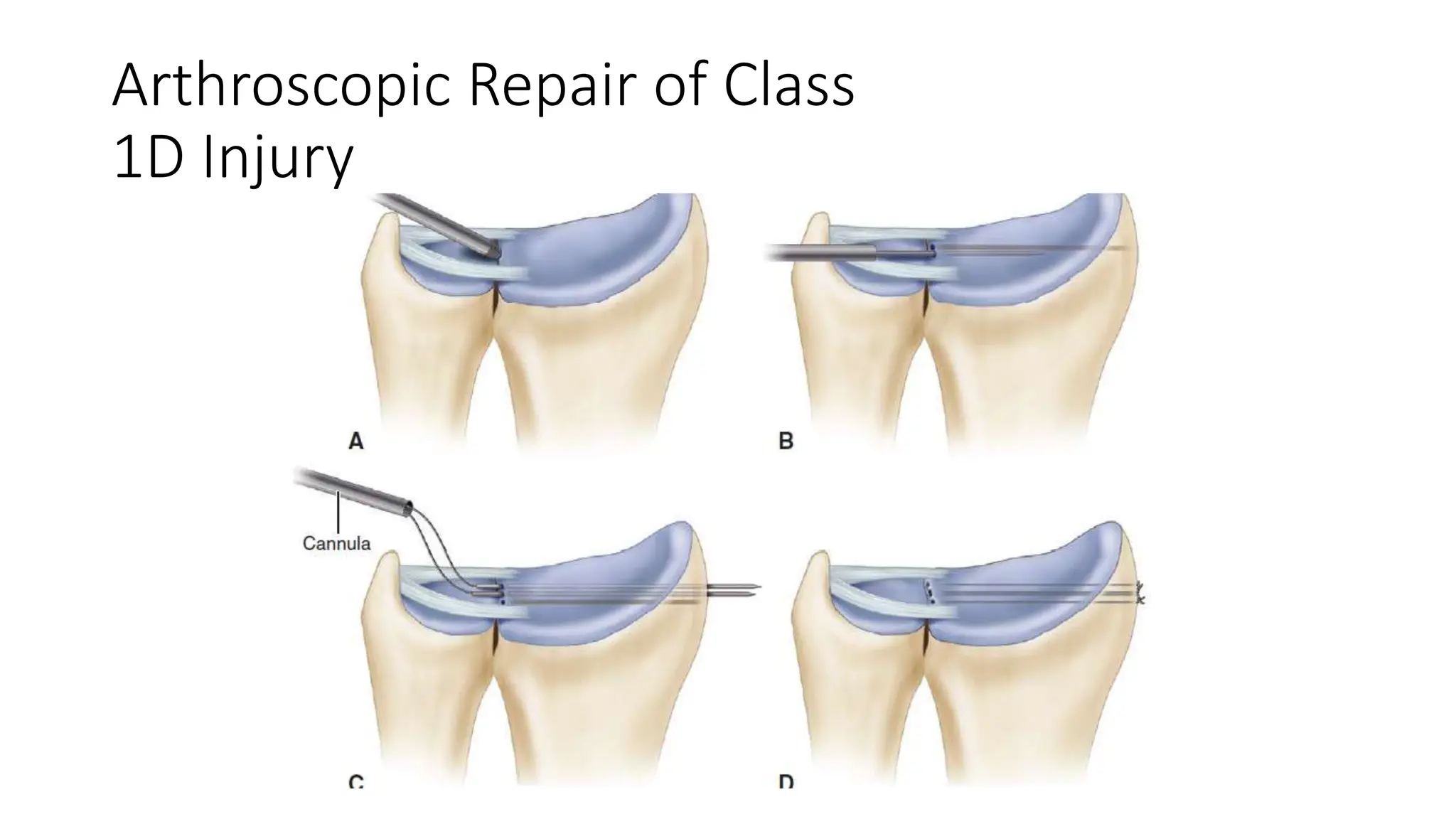 TRIANGULAR FIBROCARTILAGE COMPLEX, TFCC INJURY , DR ARJUN , | PPTX