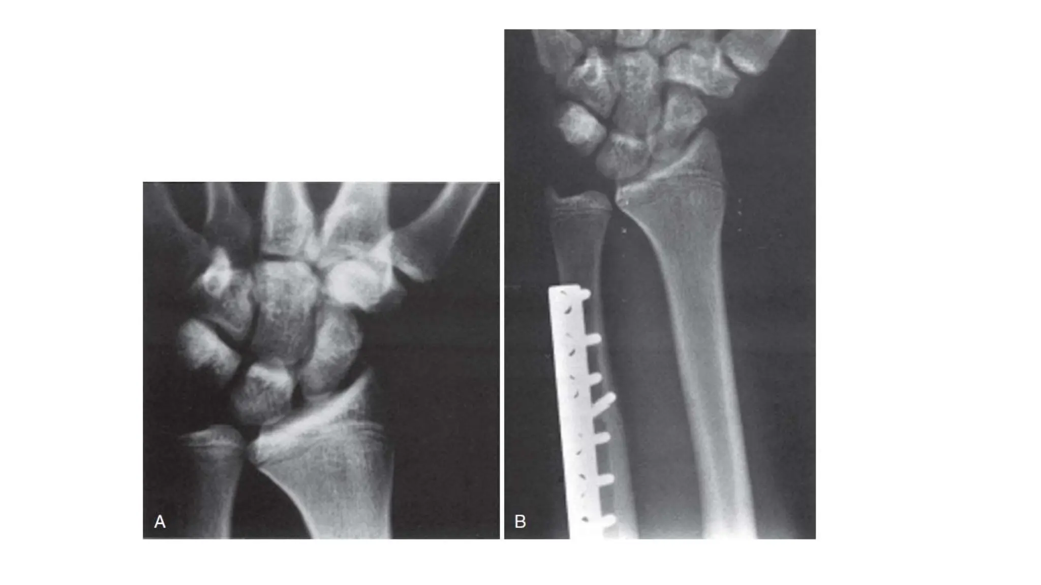 TRIANGULAR FIBROCARTILAGE COMPLEX, TFCC INJURY , DR ARJUN , | PPTX