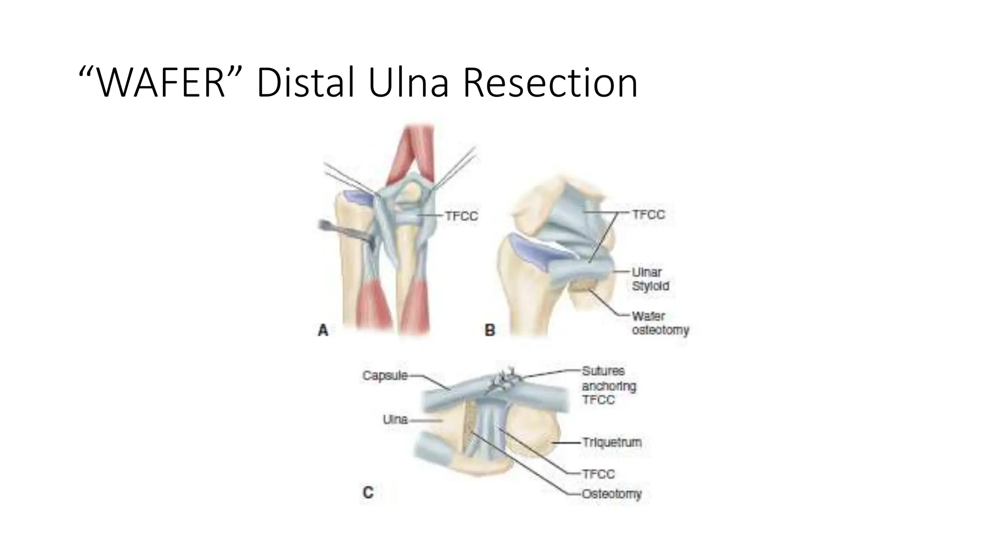 TRIANGULAR FIBROCARTILAGE COMPLEX, TFCC INJURY , DR ARJUN , | PPTX