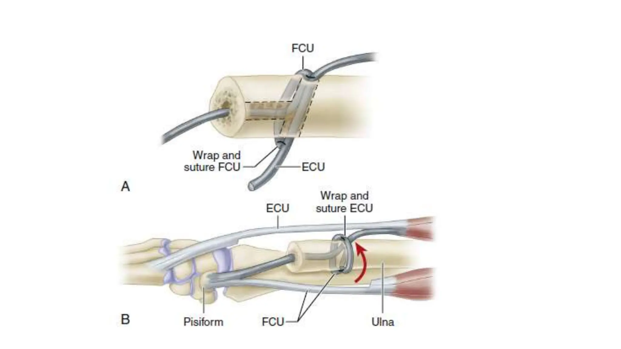 TRIANGULAR FIBROCARTILAGE COMPLEX, TFCC INJURY , DR ARJUN , | PPTX ...