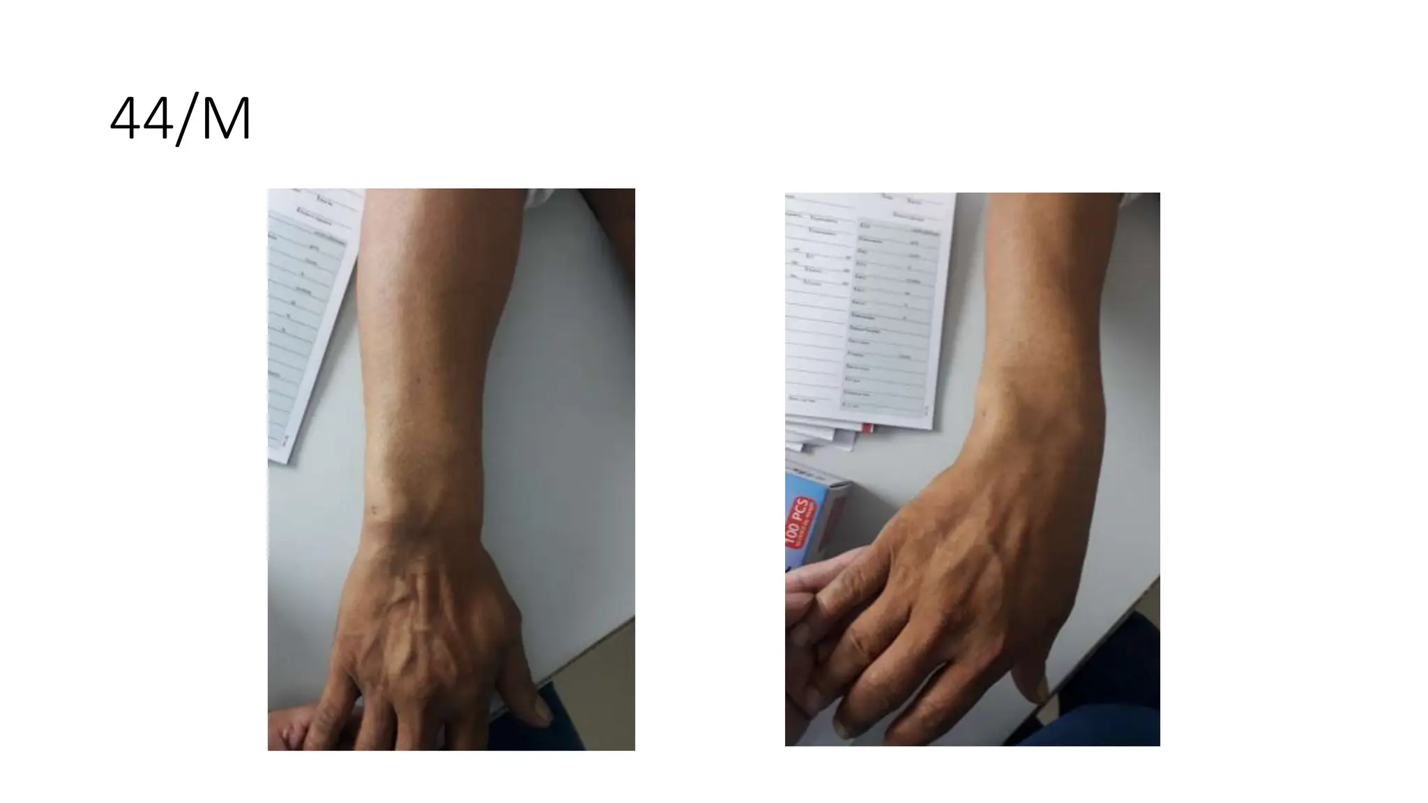 TRIANGULAR FIBROCARTILAGE COMPLEX, TFCC INJURY , DR ARJUN , | PPTX