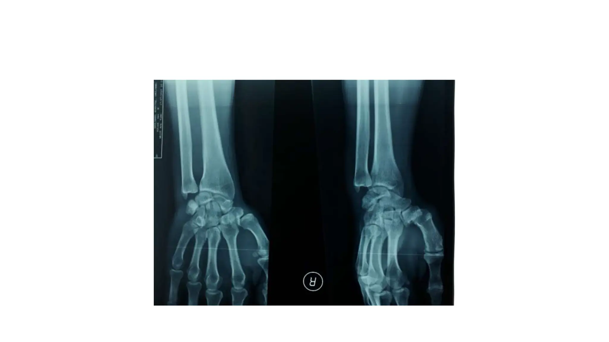 TRIANGULAR FIBROCARTILAGE COMPLEX, TFCC INJURY , DR ARJUN , | PPTX