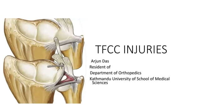TRIANGULAR FIBROCARTILAGE COMPLEX, TFCC INJURY , DR ARJUN , | PPTX | Death, Injury, or Military ...