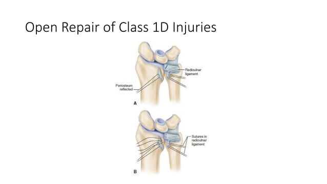 TRIANGULAR FIBROCARTILAGE COMPLEX, TFCC INJURY , DR ARJUN , | PPTX | Death, Injury, or Military ...