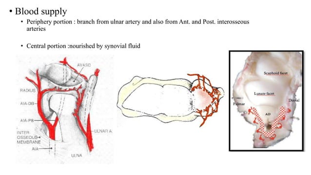 TRIANGULAR FIBROCARTILAGE COMPLEX, TFCC INJURY , DR ARJUN , | PPTX ...