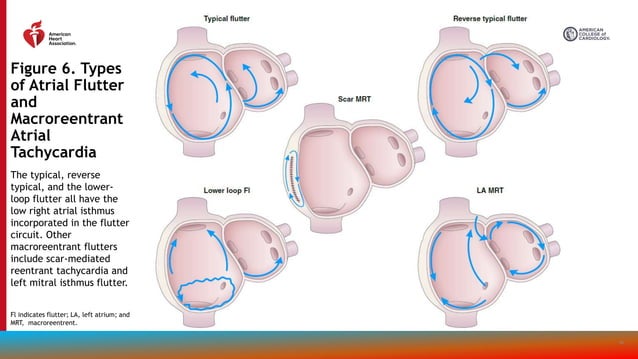 2023-Atrial-Fibrillation-Guideline-Slide-Set-gl-af.pptx | Heart and Cardiovascular Diseases ...