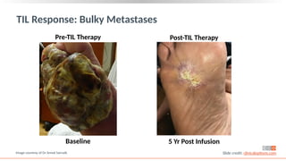 2023-melanoma-til-therapy_Sarnaik 2023.pptx