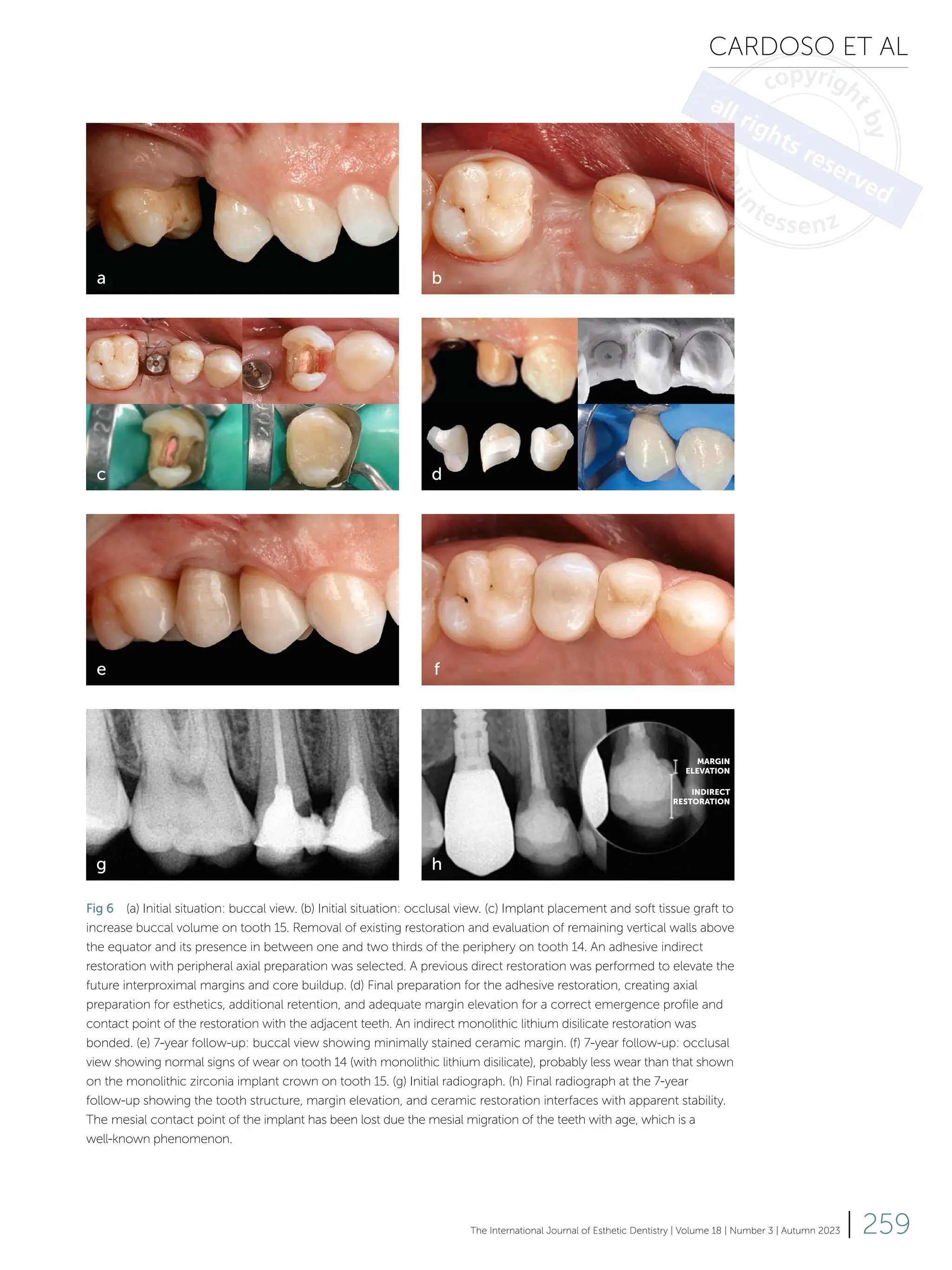 2023 Clinical guidelines for posterior restorations based on Coverage ...
