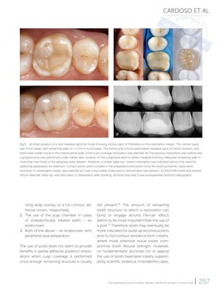 2023 Clinical guidelines for posterior restorations based on Coverage ...