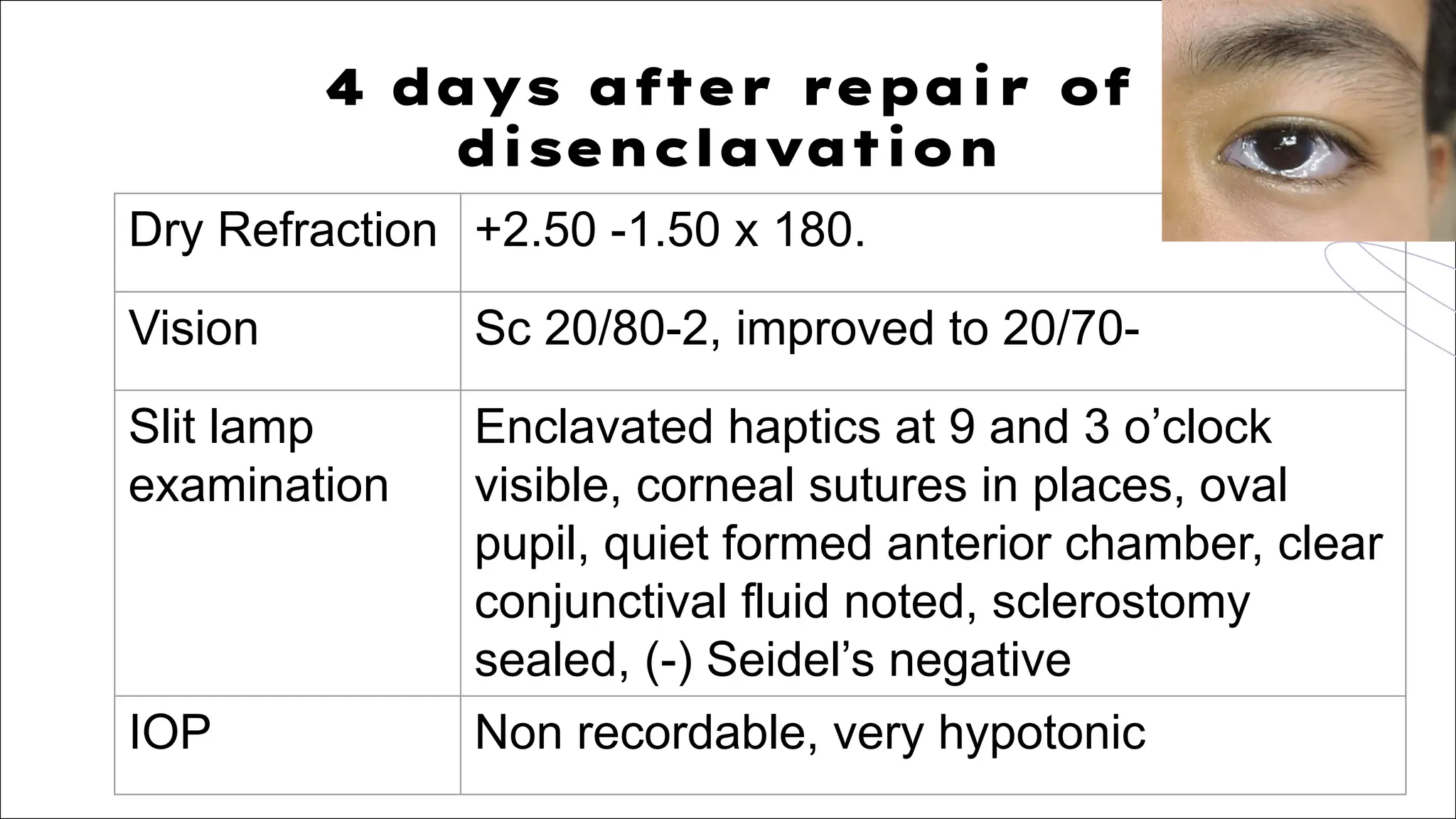 Ocular hypotony following reenclavation of a partially dislocated ...