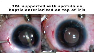 Ocular hypotony following reenclavation of a partially dislocated ...