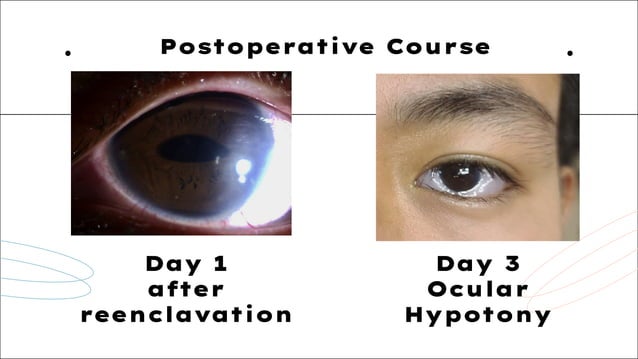 Ocular hypotony following reenclavation of a partially dislocated ...