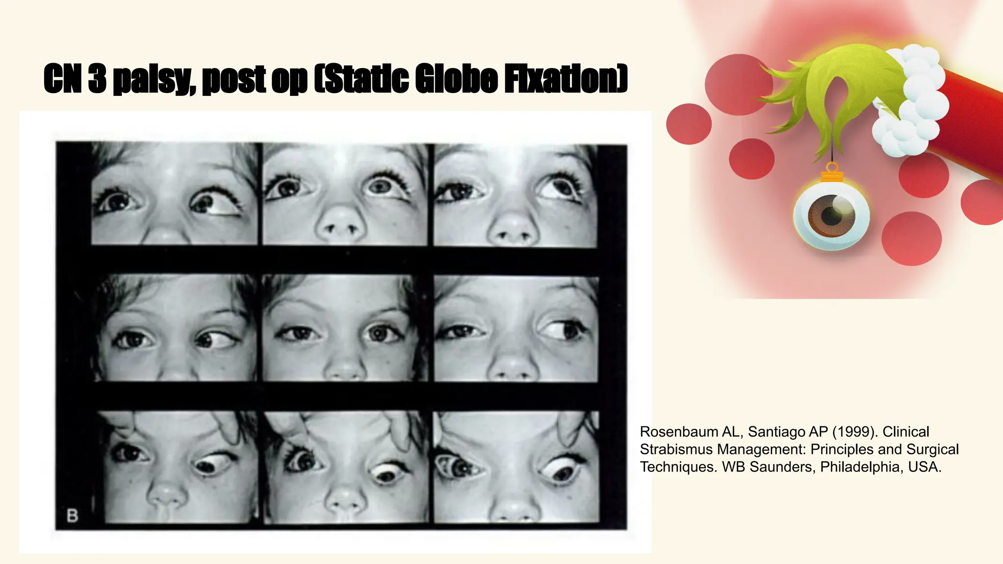 Strabismus Surgeries for Cranial Nerve Palsies | PDF